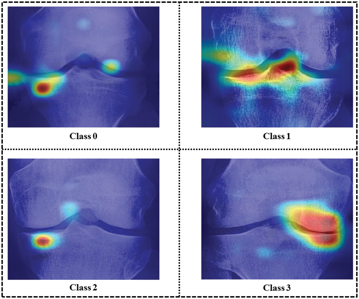 CSSE | Free Full-Text | Knee Osteoarthritis Classification Using X-Ray ...