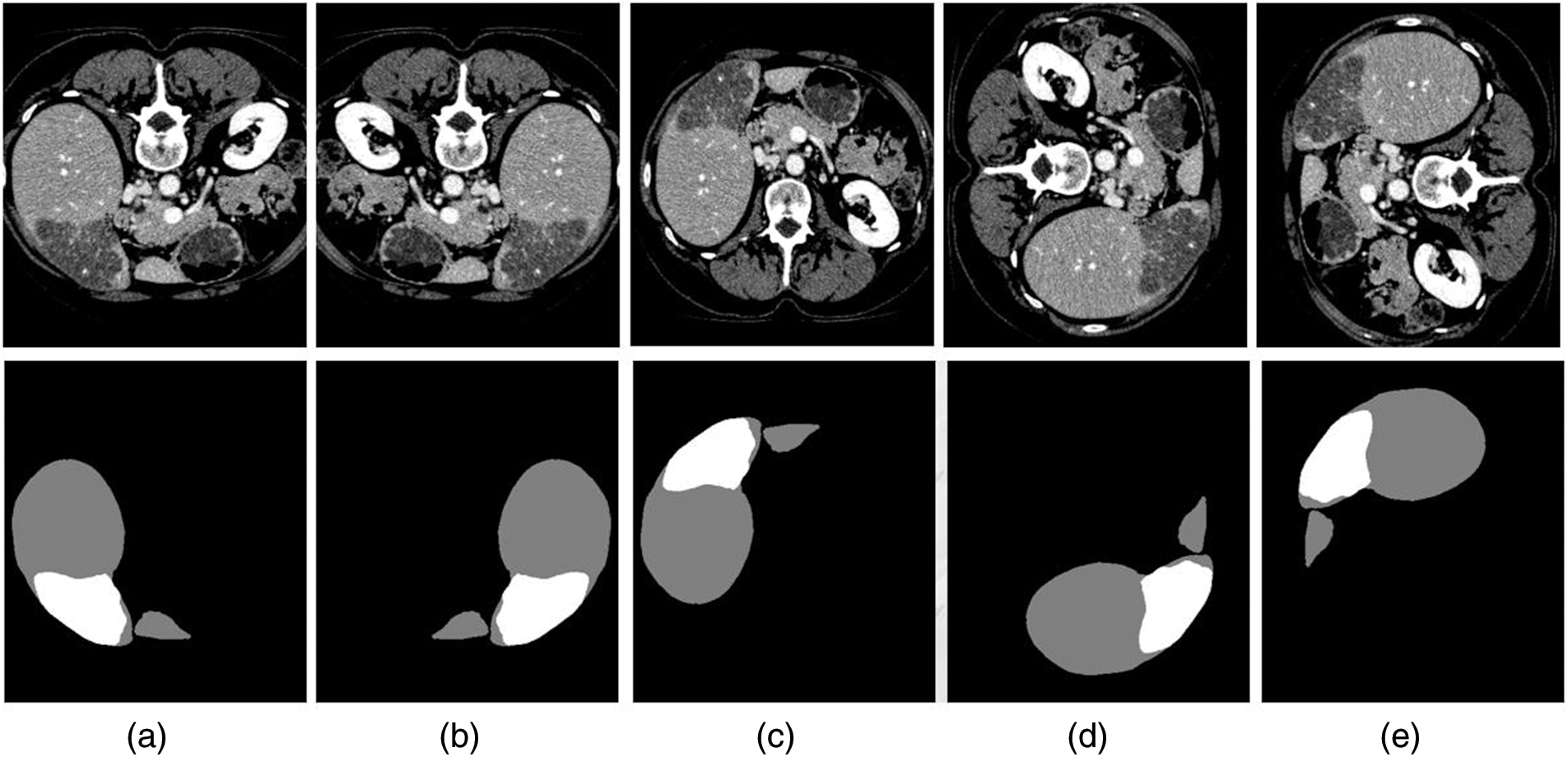 CSSE | Free Full-Text | Liver Tumor Segmentation Based on Multi-Scale and Self-Attention Mechanism