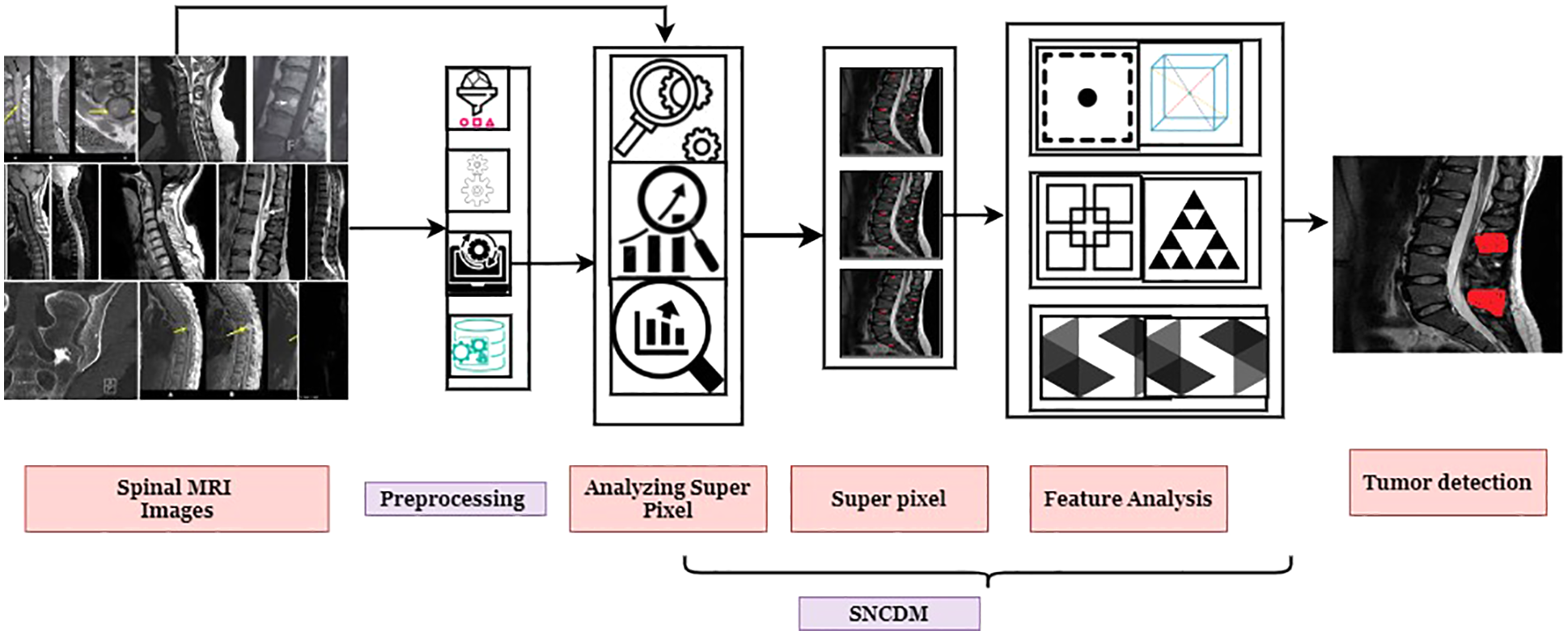 IASC | Free Full-Text | SNCDM: Spinal Tumor Detection from MRI Images ...