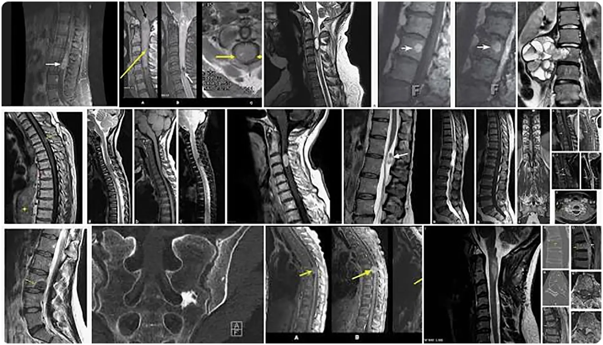 IASC | Free Full-Text | SNCDM: Spinal Tumor Detection from MRI Images ...