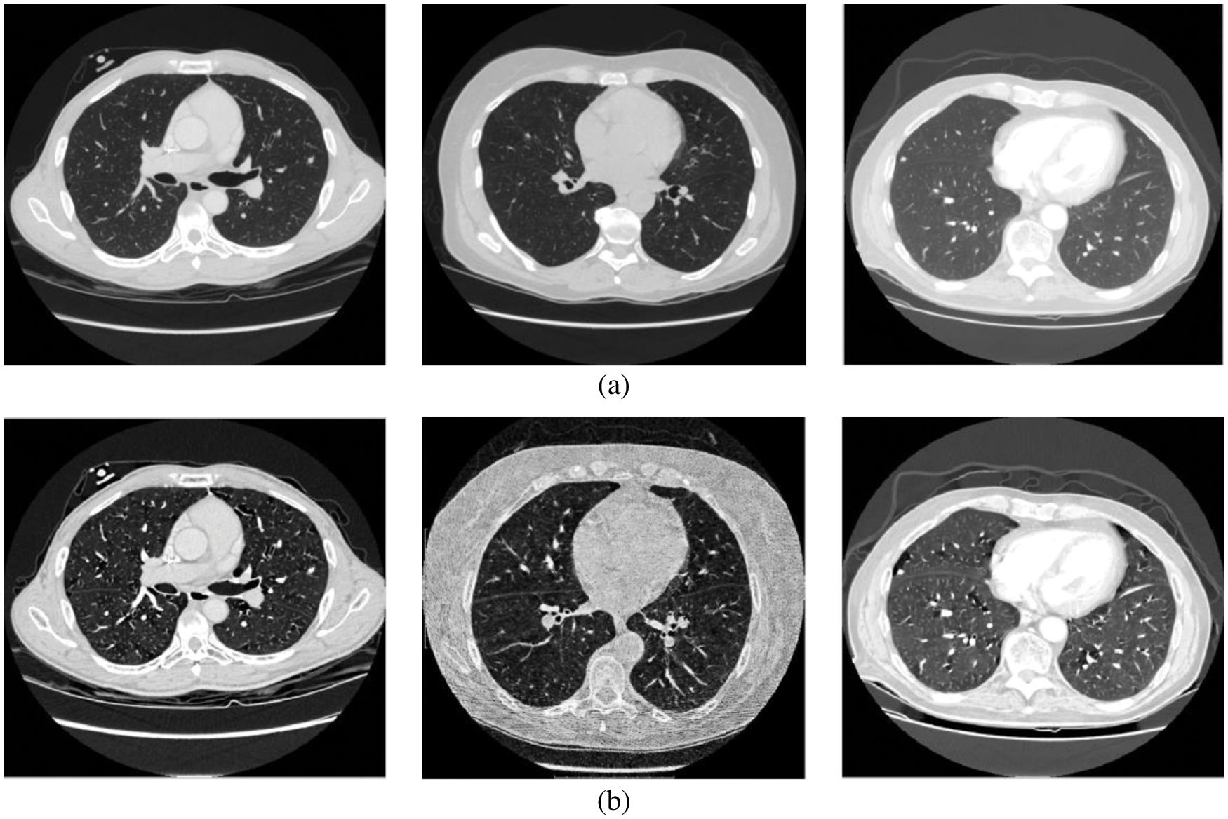 IASC | Free Full-Text | Auxiliary Classifier of Generative Adversarial Network for Lung Cancer ...