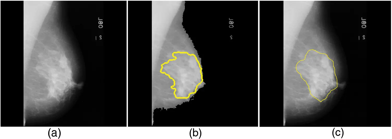 IASC | Free Full-Text | Cancer Regions in Mammogram Images Using ANFIS ...