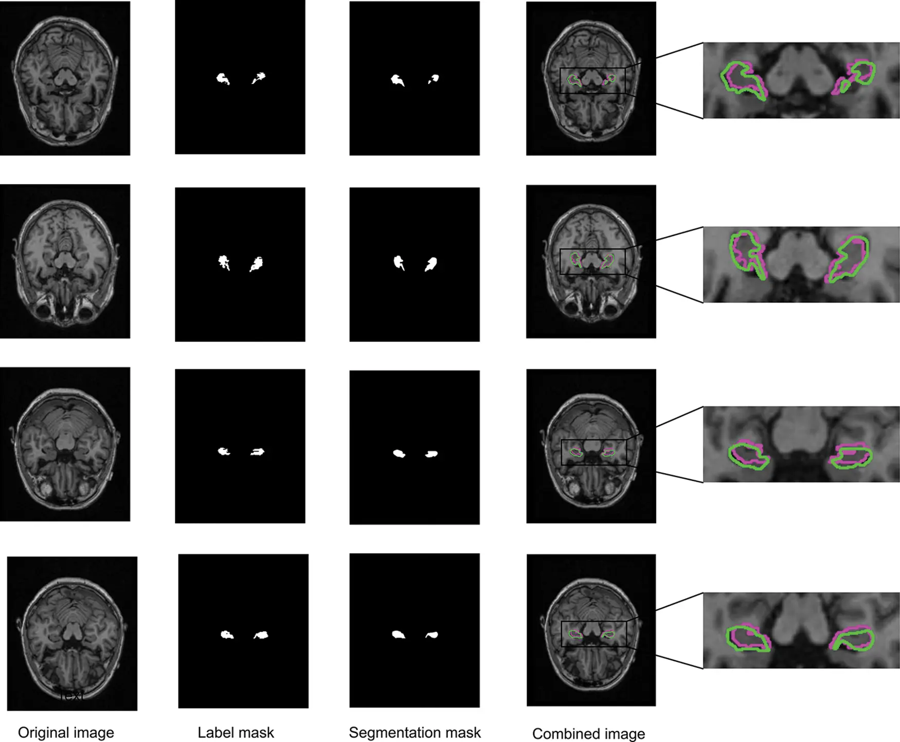 IASC | Free Full-Text | SC-Net: A New U-Net Network for Hippocampus Segmentation
