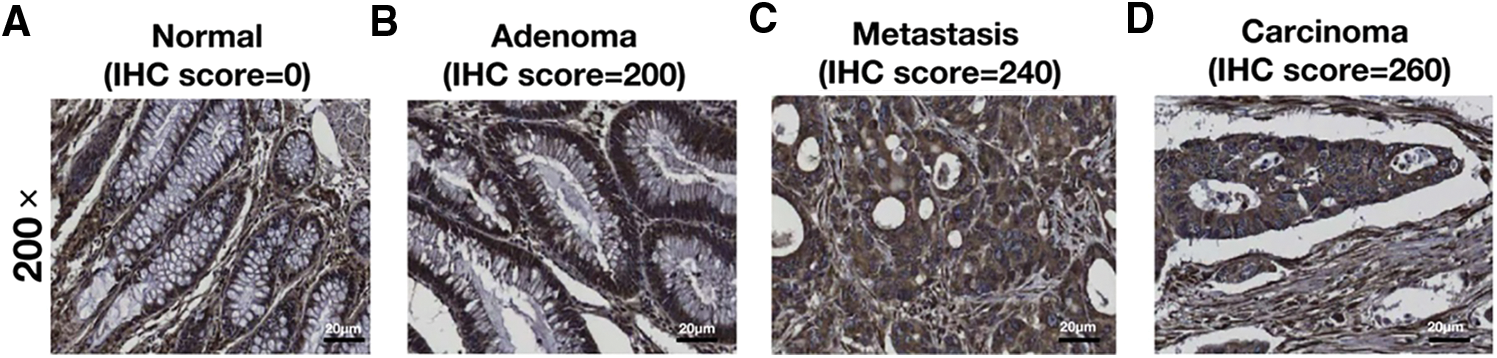ONCOLOGIE | Free Full-Text | RCN3 Expression Indicates Prognosis in ...
