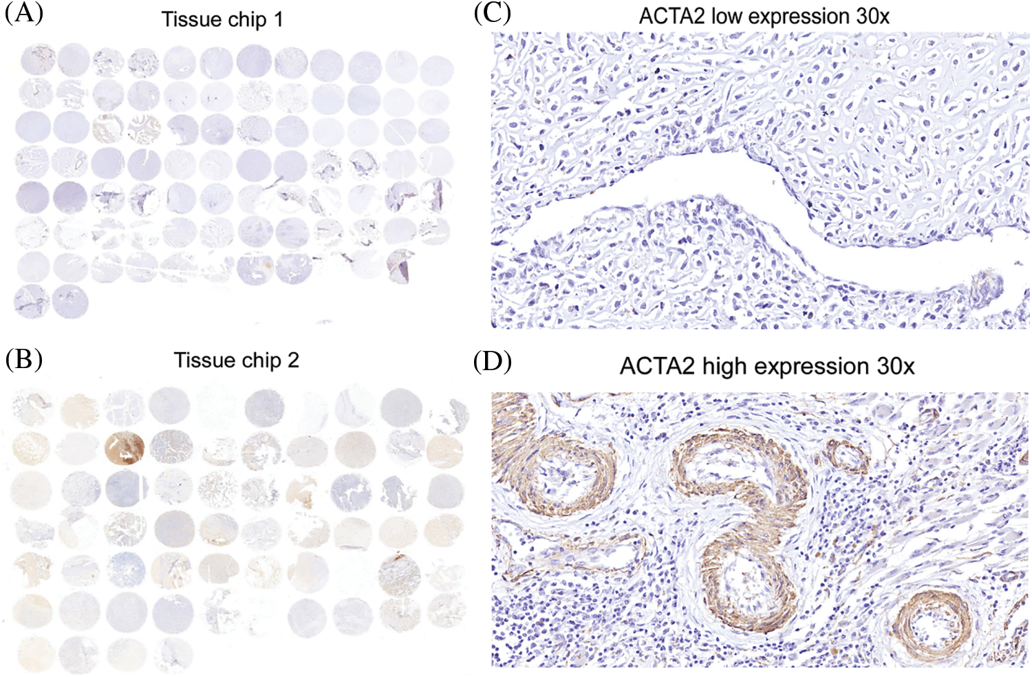 ONCOLOGIE | Free Full-Text | Expression and Clinical Significance of ...