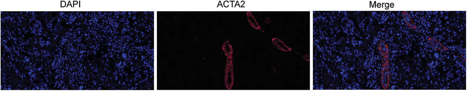 ONCOLOGIE | Free Full-Text | Expression and Clinical Significance of ...