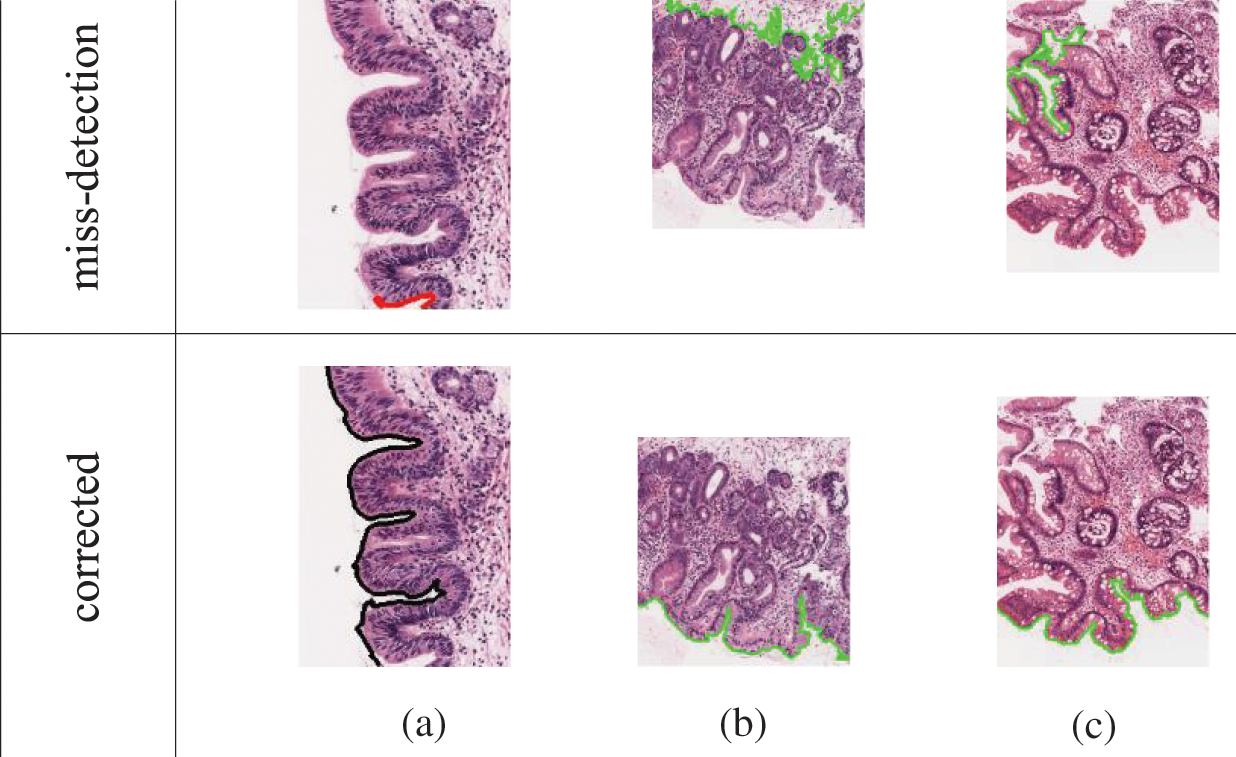 Epithelial Layer Estimation Using Curvatures And Textural Features For Dysplastic Tissue Detection