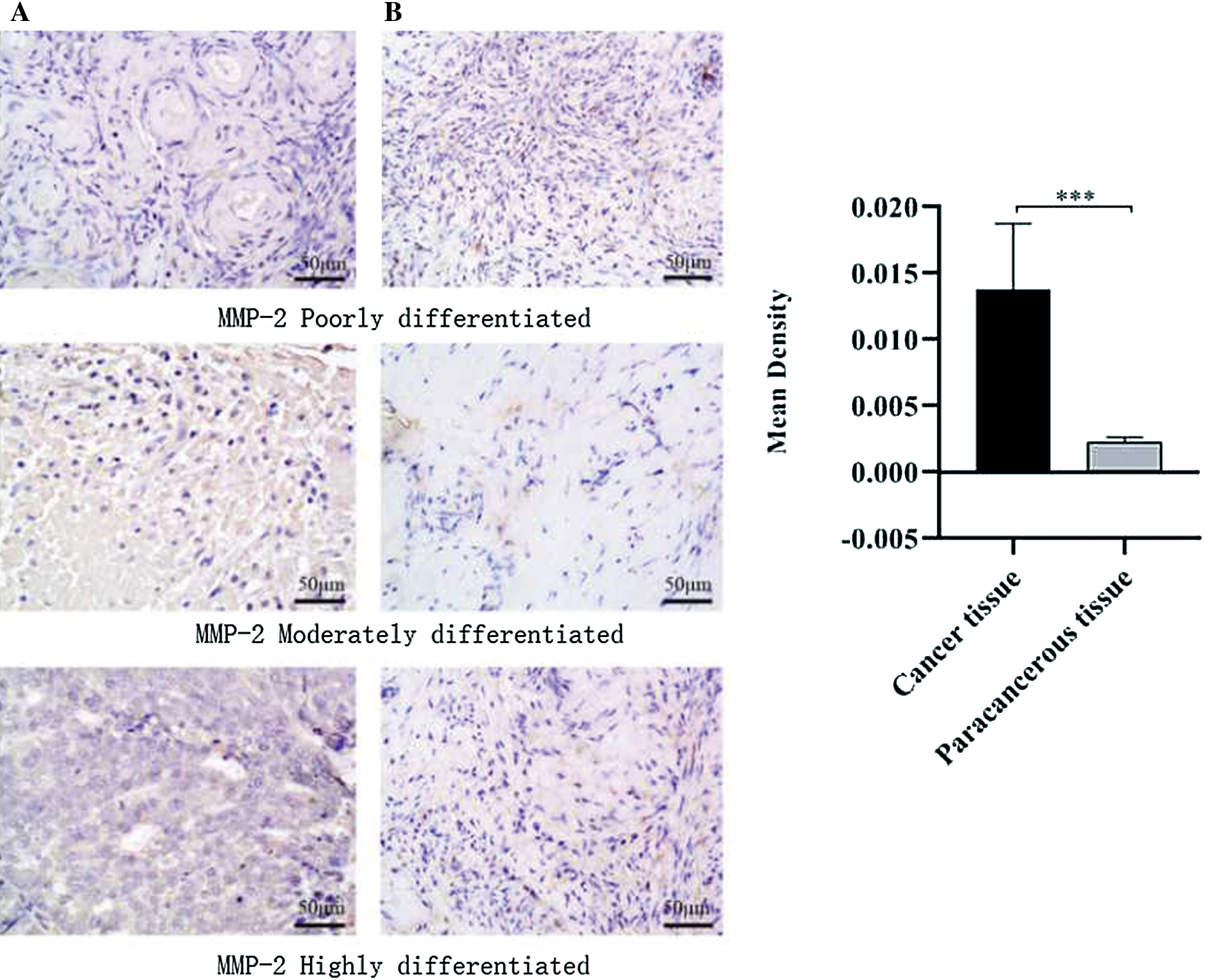 Study on the clinical significance of TRPV2 and MMP2 expressions in ...
