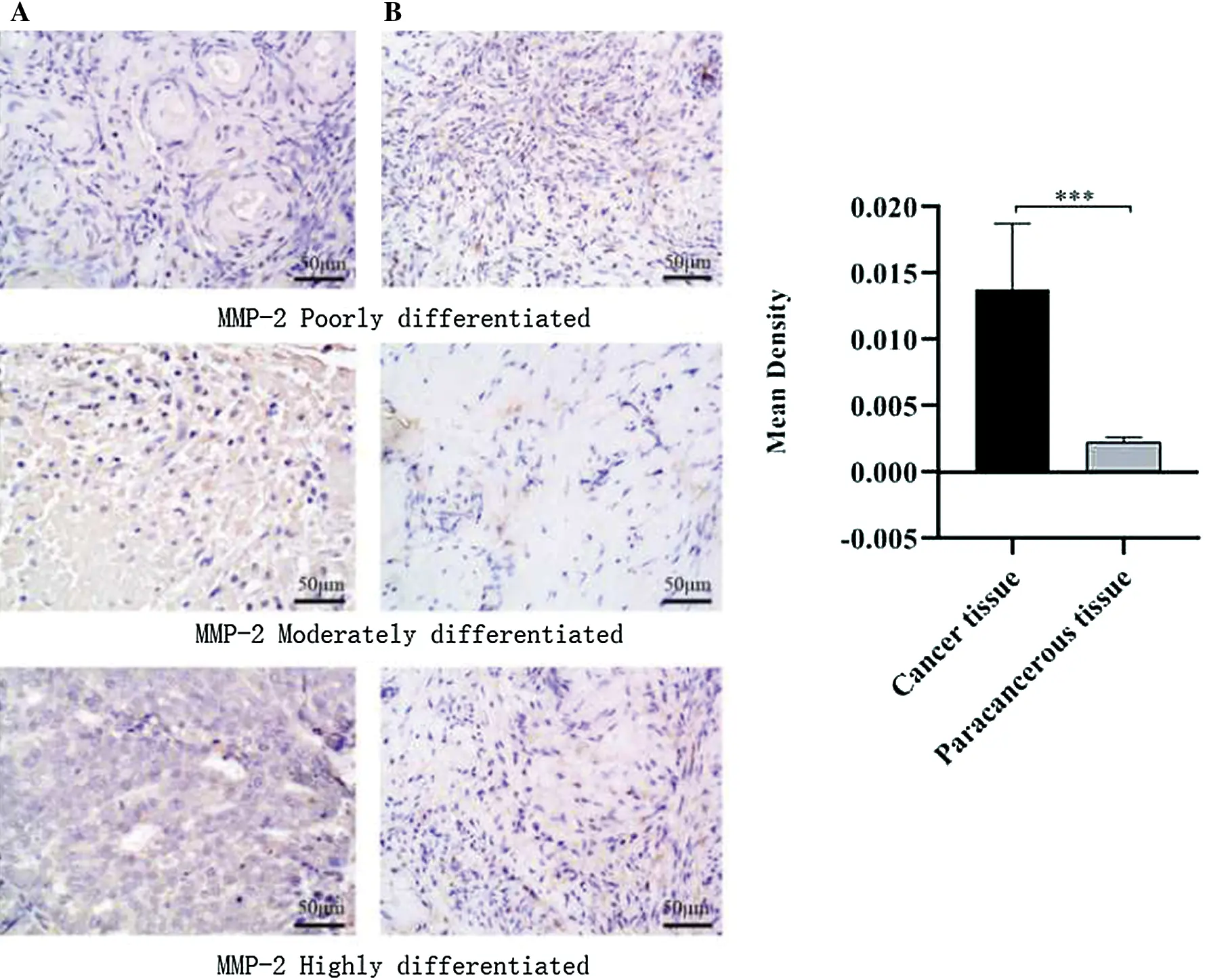 Study on the clinical significance of TRPV2 and MMP2 expressions in ...