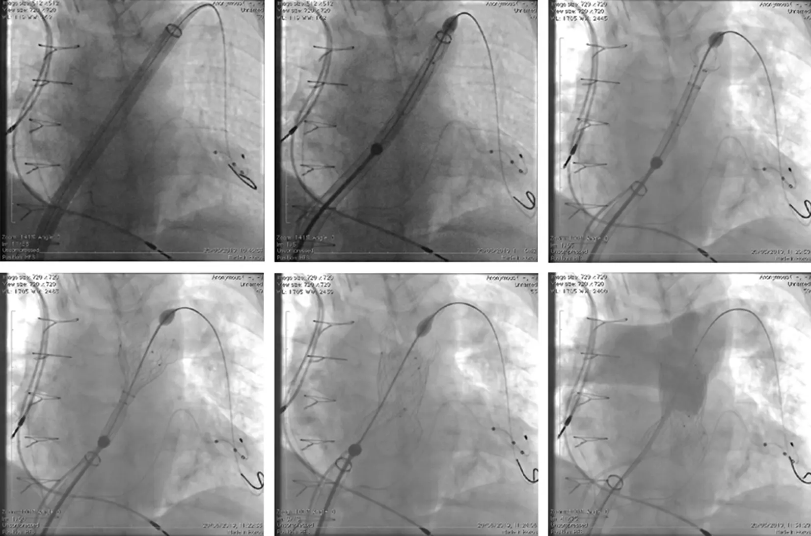 Use of the GORE® DrySeal Flex Introducer Sheath to Facilitate ...