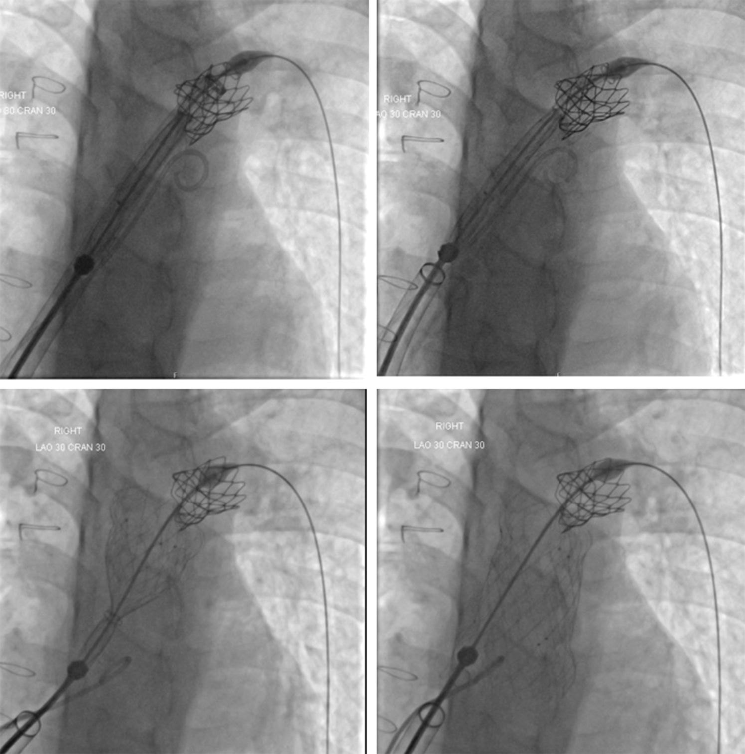 Use of the GORE® DrySeal Flex Introducer Sheath to Facilitate ...