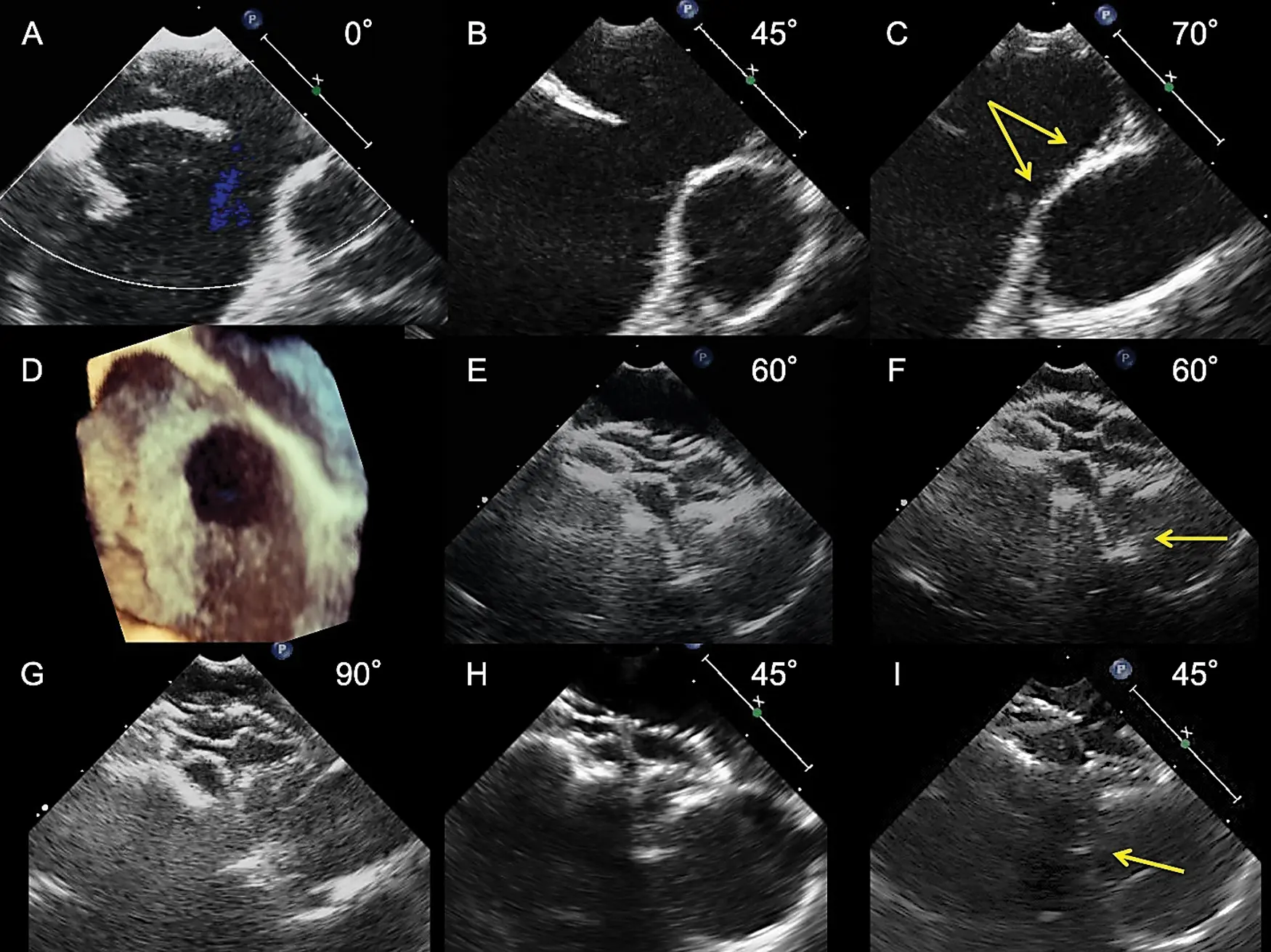 Efficacy and Safety of the Atrial Septal Defect Closure for Patients ...