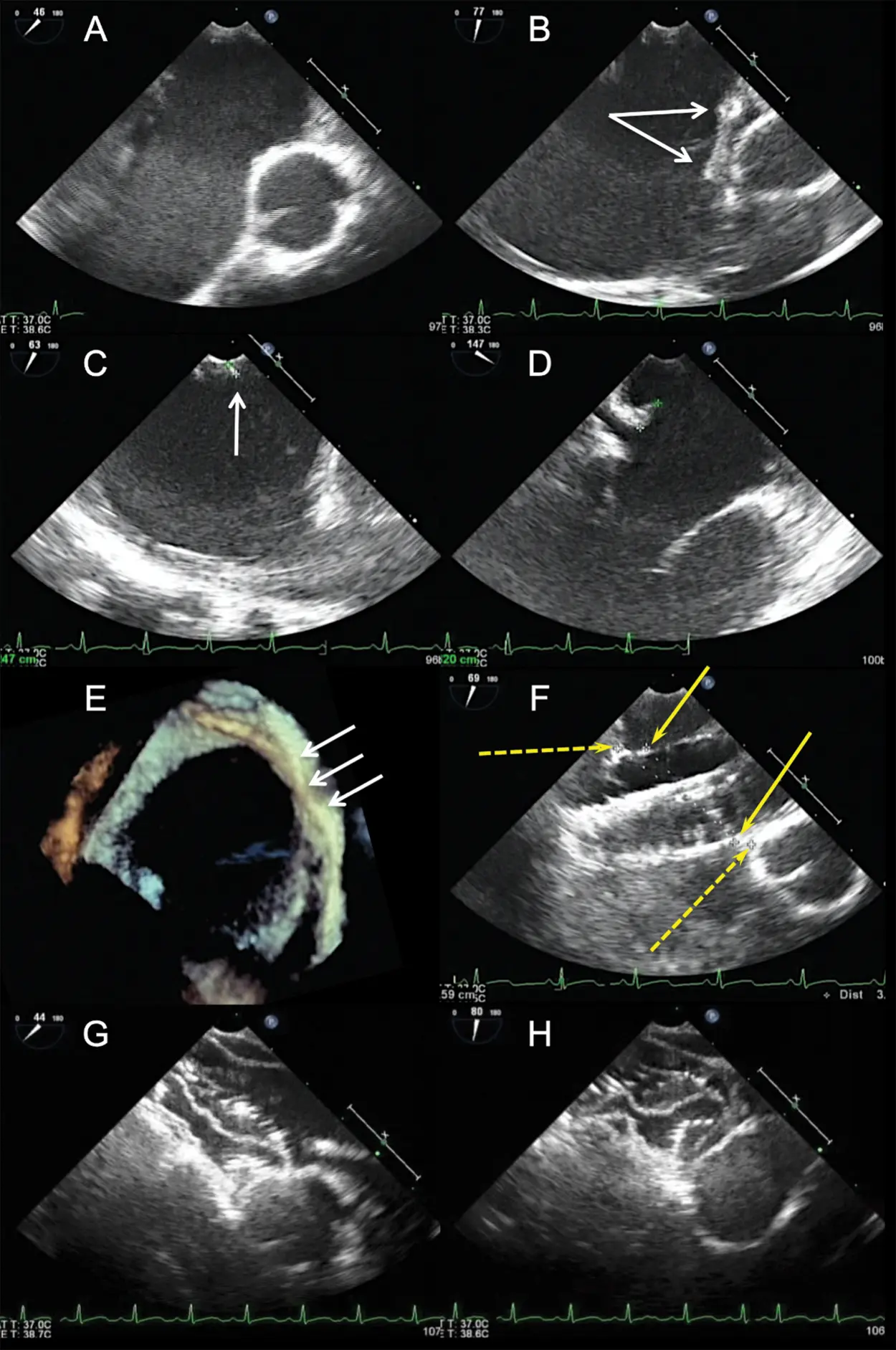 Efficacy and Safety of the Atrial Septal Defect Closure for Patients ...