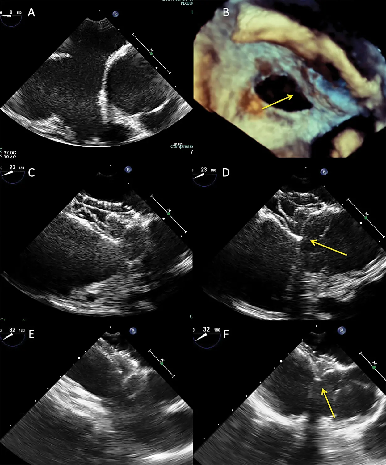 Efficacy and Safety of the Atrial Septal Defect Closure for Patients ...