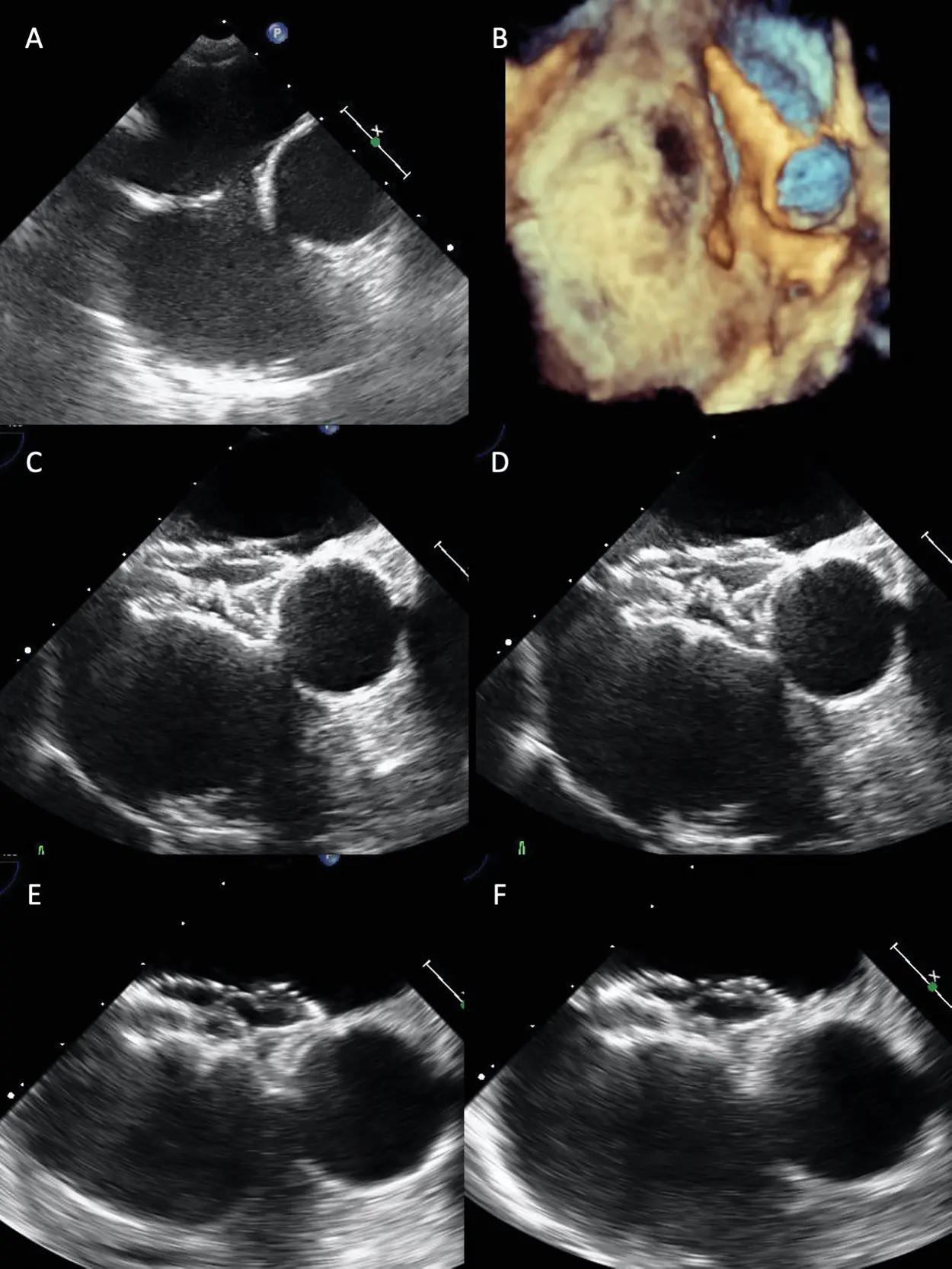 Efficacy and Safety of the Atrial Septal Defect Closure for Patients ...