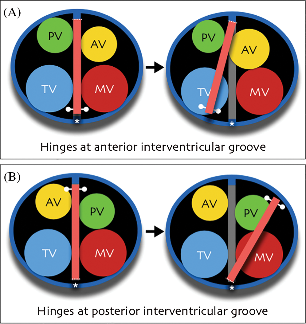 Characterization of Malalignment between Atrial and Ventricular Septa ...