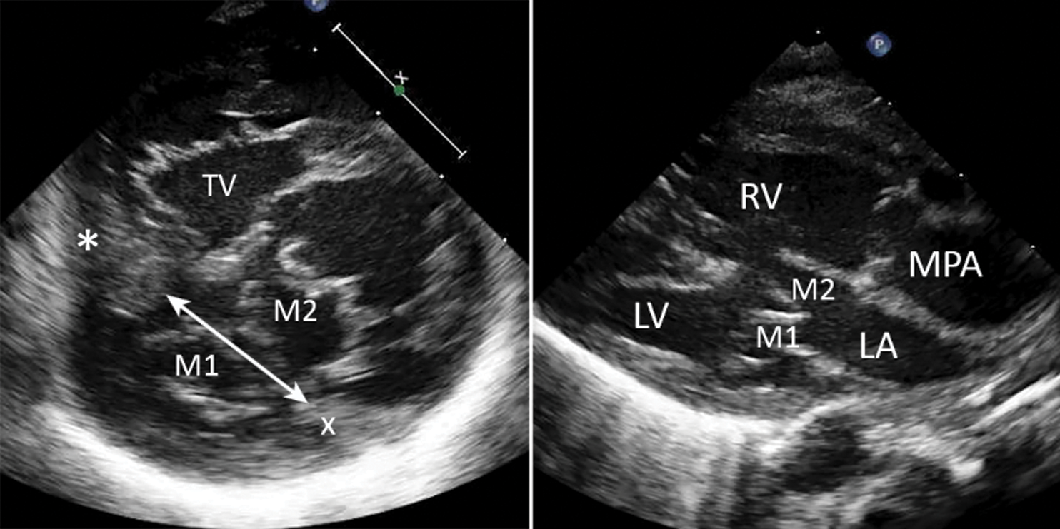 Characterization of Malalignment between Atrial and Ventricular Septa ...