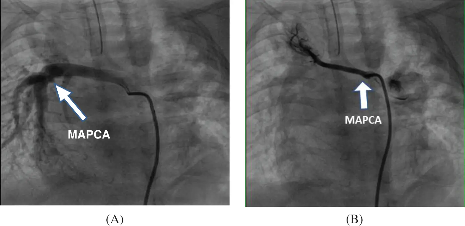 The Clinical Application Value of Selective Unifocalization in the ...