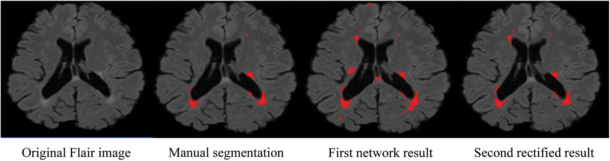 Automatic and Robust Segmentation of Multiple Sclerosis Lesions with Convolutional Neural Networks