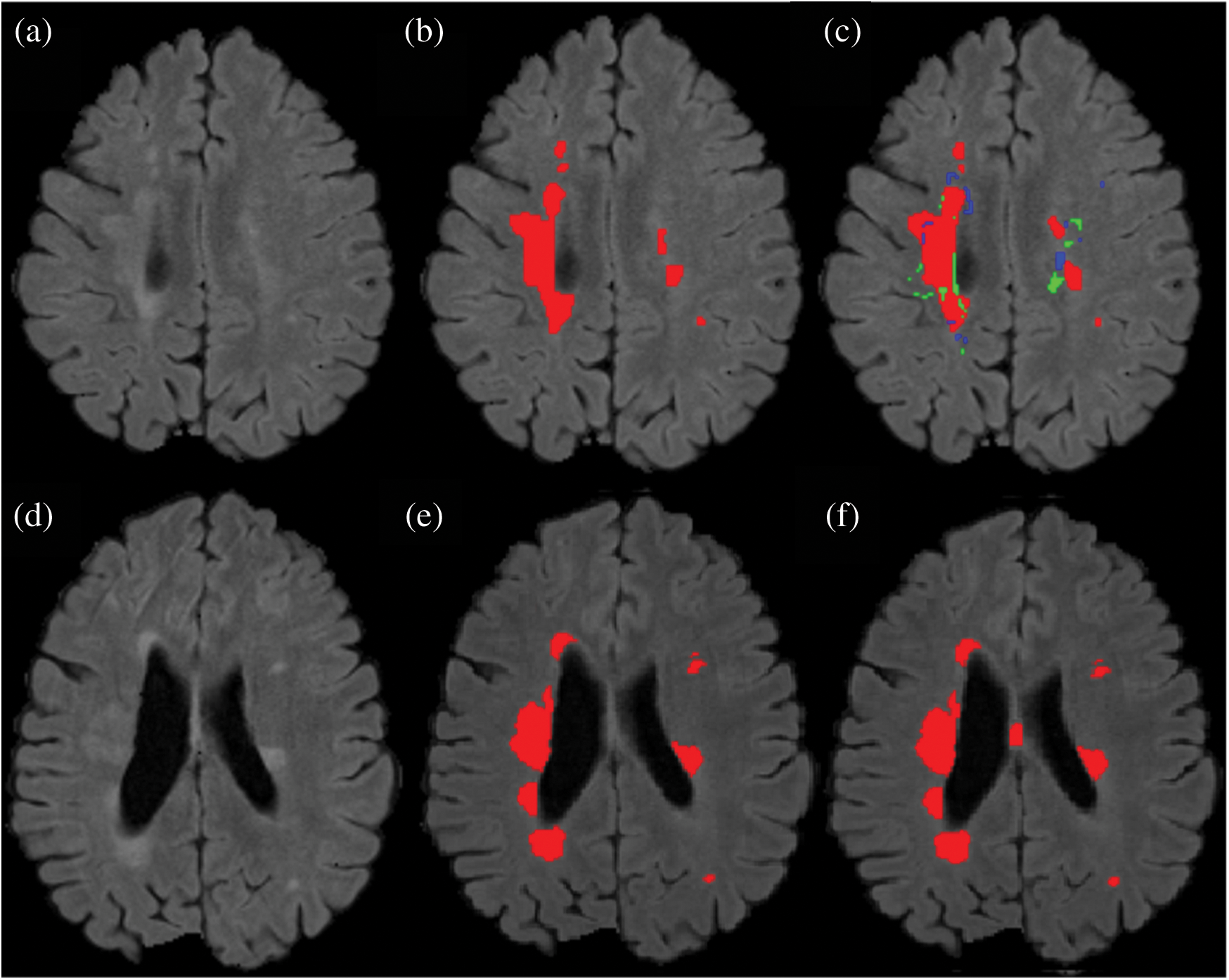 Automatic and Robust Segmentation of Multiple Sclerosis Lesions with Convolutional Neural Networks