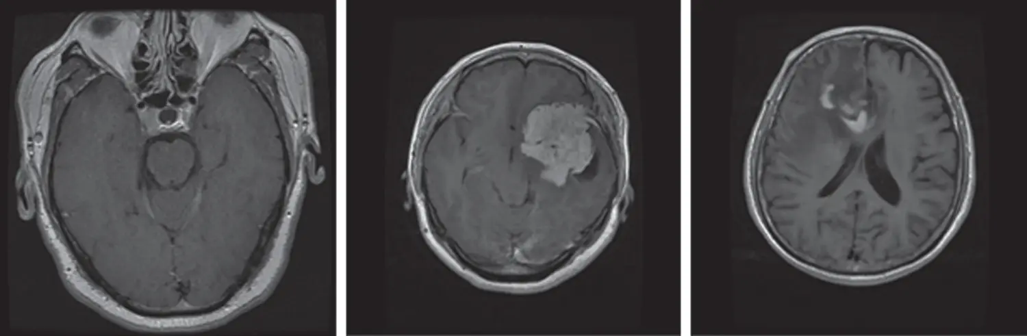 Brain Tumor Classification Based on Fine-Tuned Models and the Ensemble ...