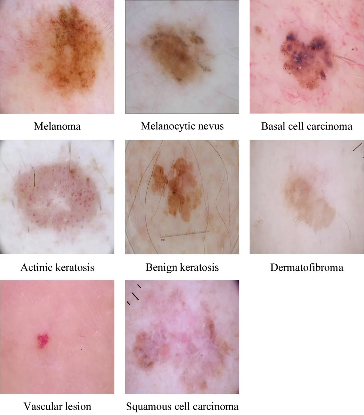 Mixed Re-Sampled Class-Imbalanced Semi-Supervised Learning for Skin ...