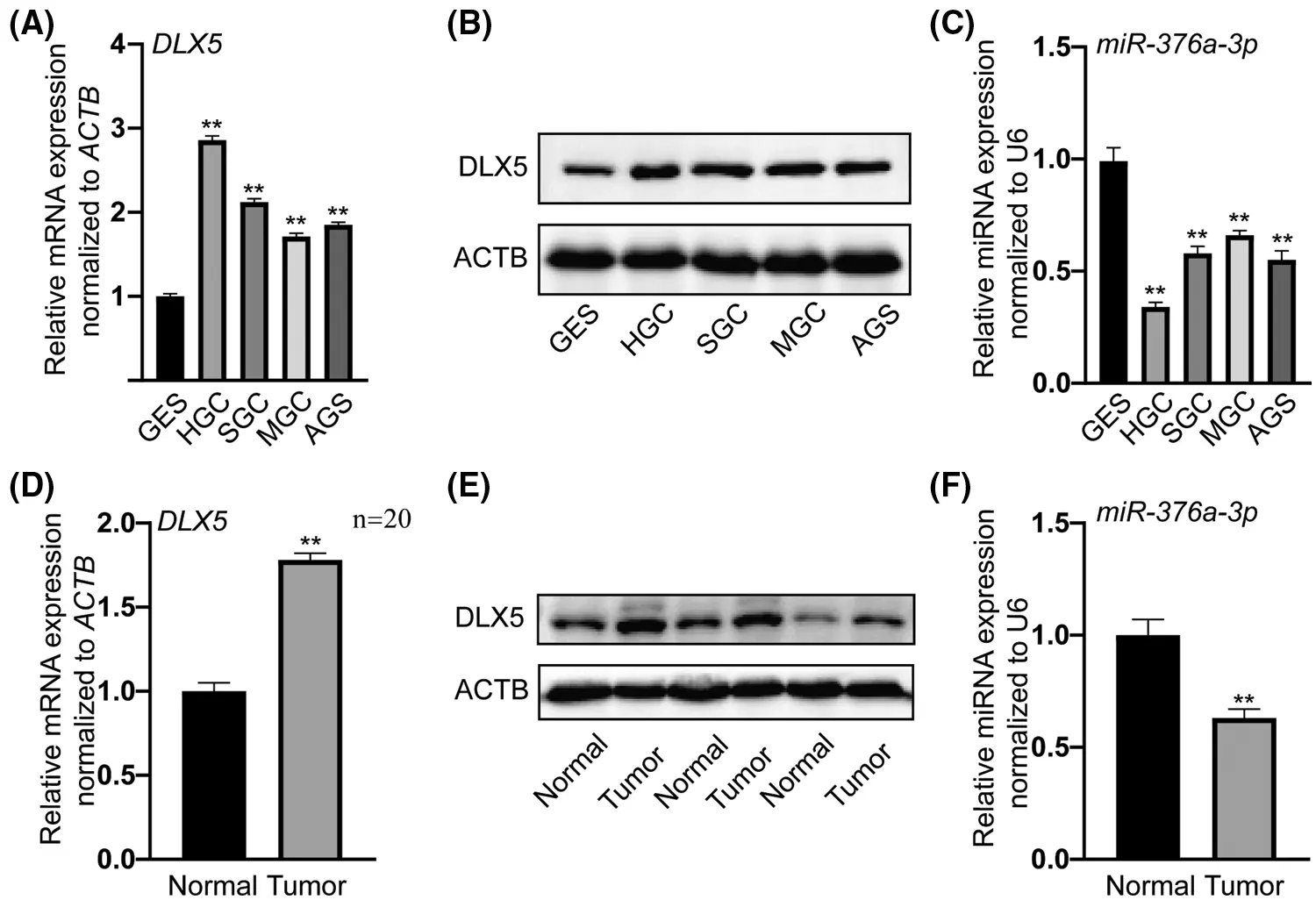 The expression and function of miR-376a-3p/DLX axis in gastric cancer cells