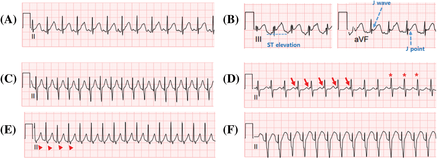 CHD | Free Full-Text | Incidence and Related Risk Factors of Junctional ...
