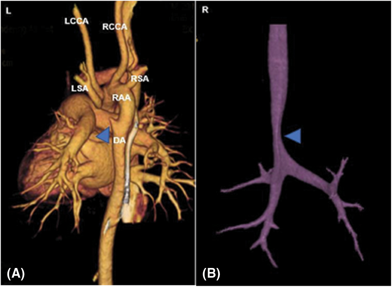 CHD | Free Full-Text | Minimally Invasive Surgical Technique in Double ...
