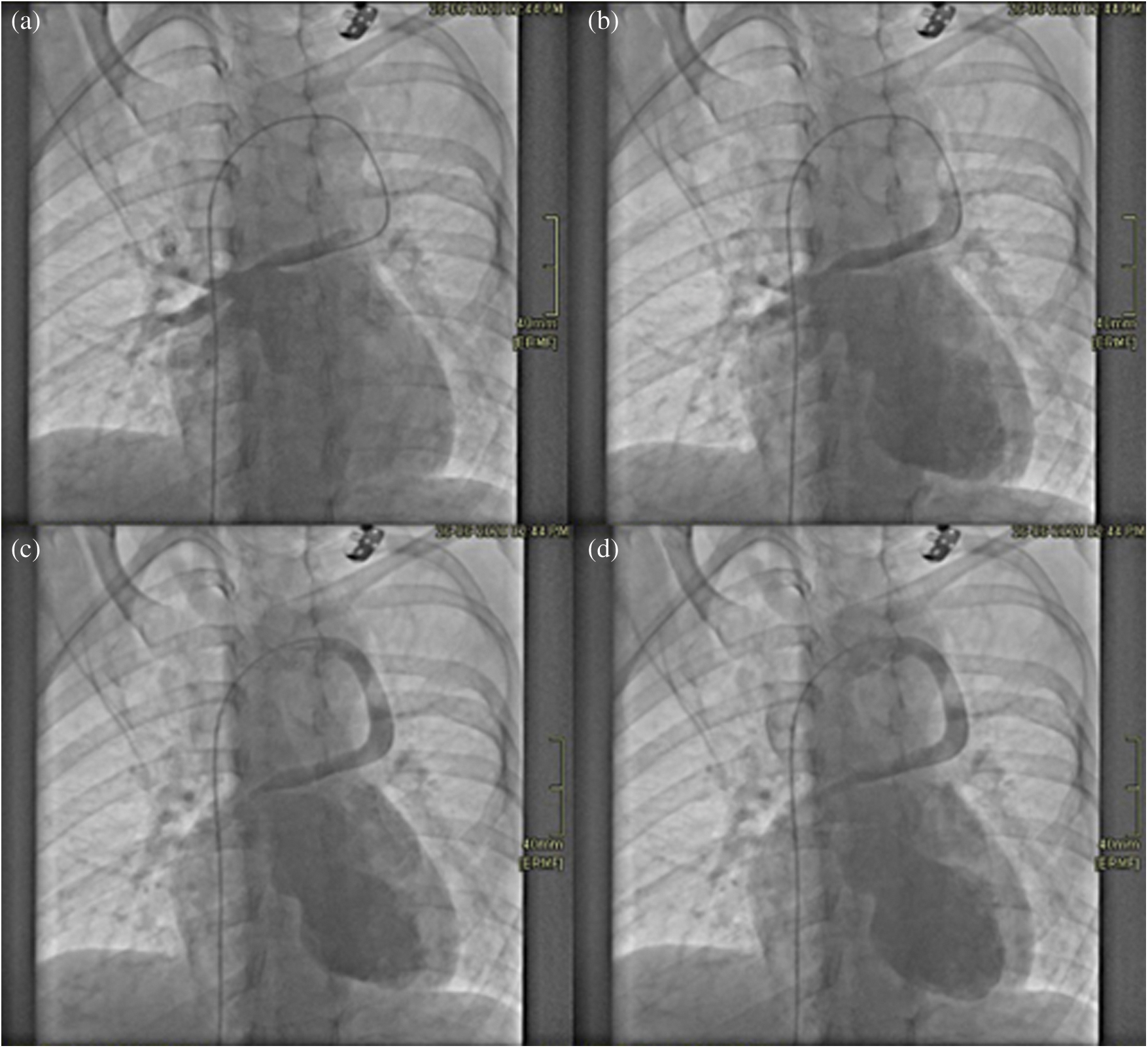 Percutaneous Occlusion of Right Partial Anomalous Pulmonary Venous ...
