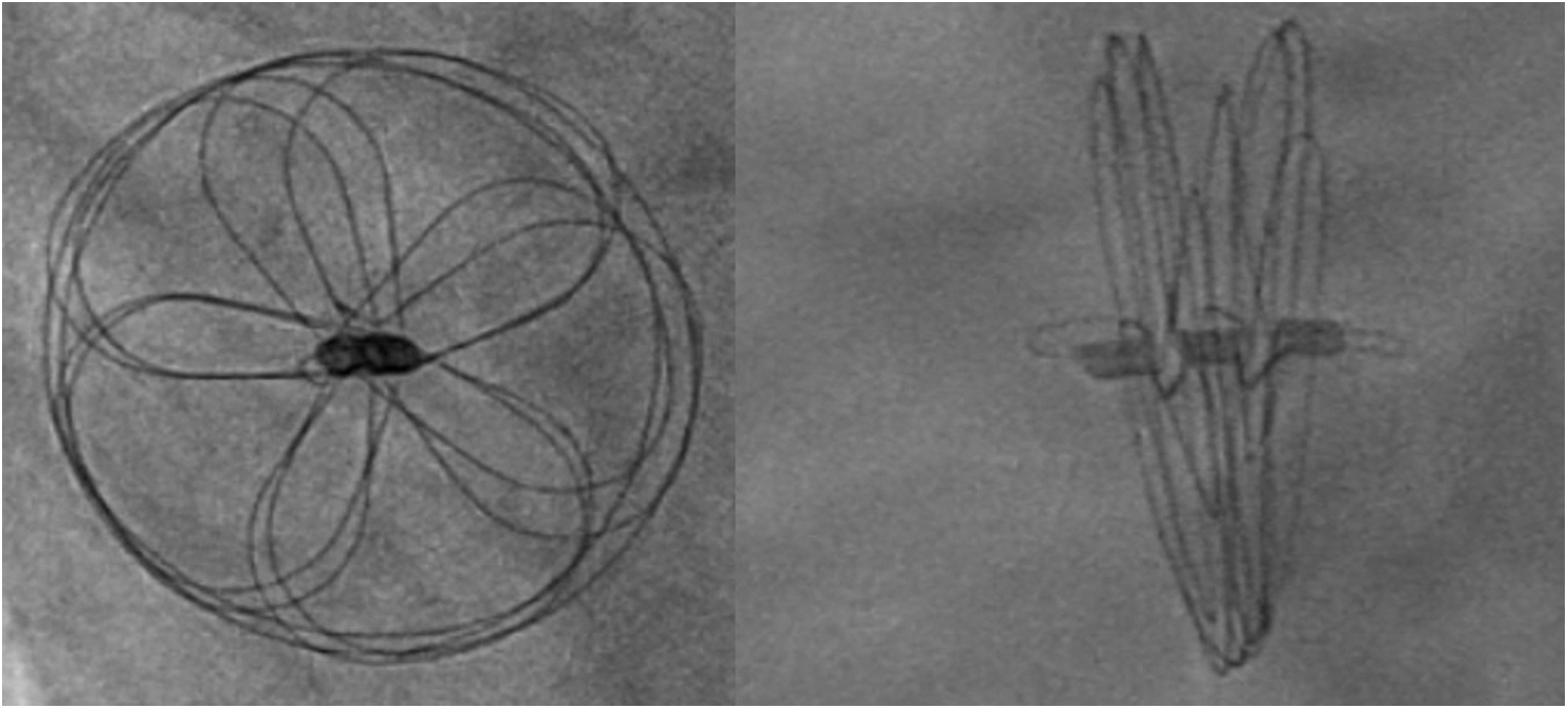 Percutaneous Closure of Patent Foramen Ovale and Secundum Atrial Septal ...