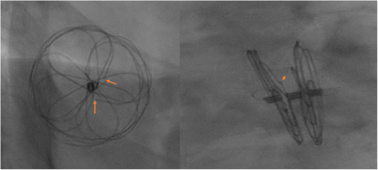 Percutaneous Closure of Patent Foramen Ovale and Secundum Atrial Septal ...