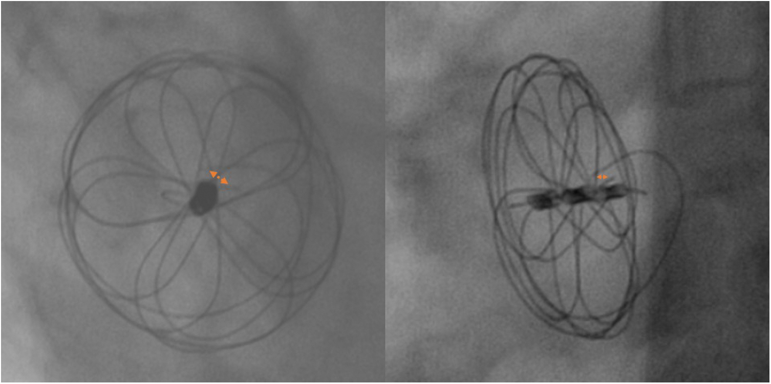 Percutaneous Closure of Patent Foramen Ovale and Secundum Atrial Septal ...