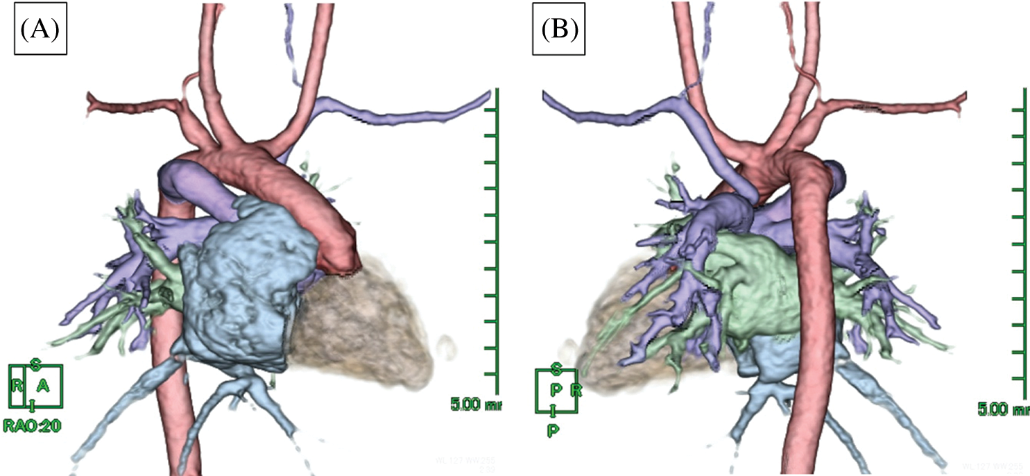 Isolation of the Left Subclavian Artery in D-Transposition of the Great Arteries with Right ...