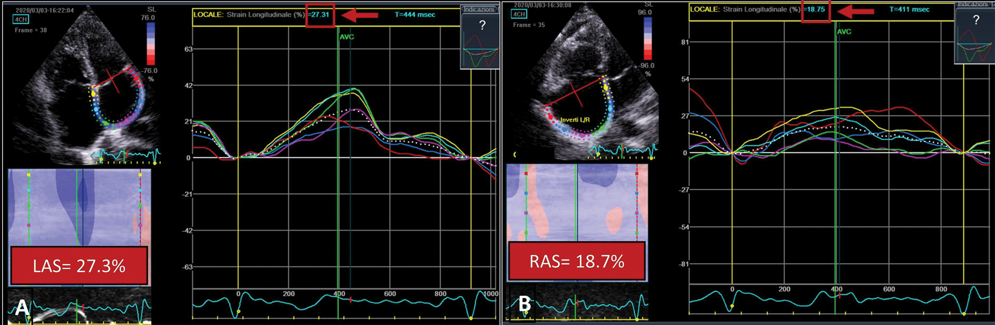 Scimitar Syndrome: Role of Right Atrial Longitudinal Strain. A Case Report