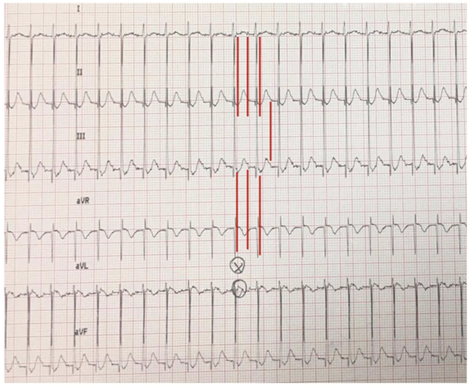 Arrhythmias in Common Arterial Trunk (CAT): Uncommon Atrial Tachycardia ...
