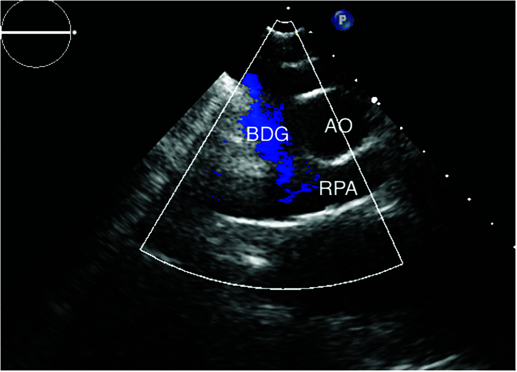The Glenn Shunt Revisited, A Single Center Registry in Ain Shams ...