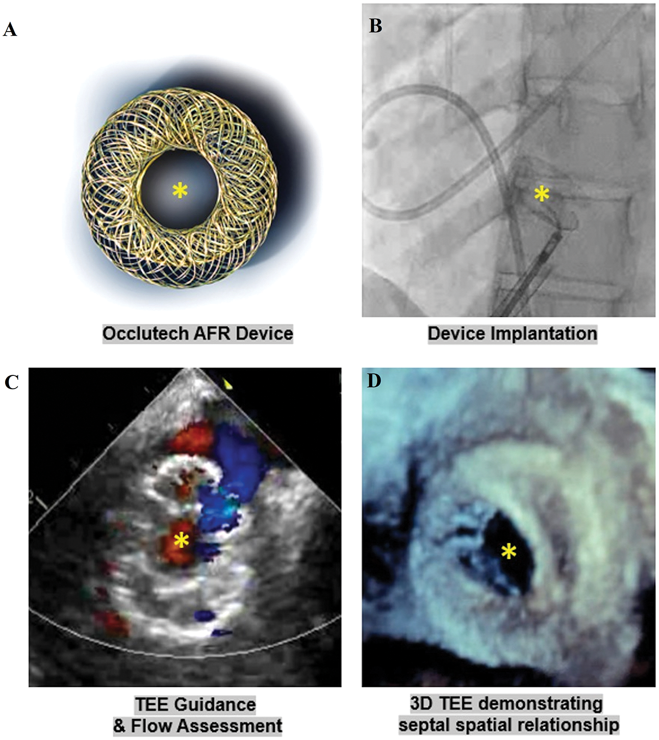 Multi-Institutional US Experience of the Occlutech© AFR Device in ...