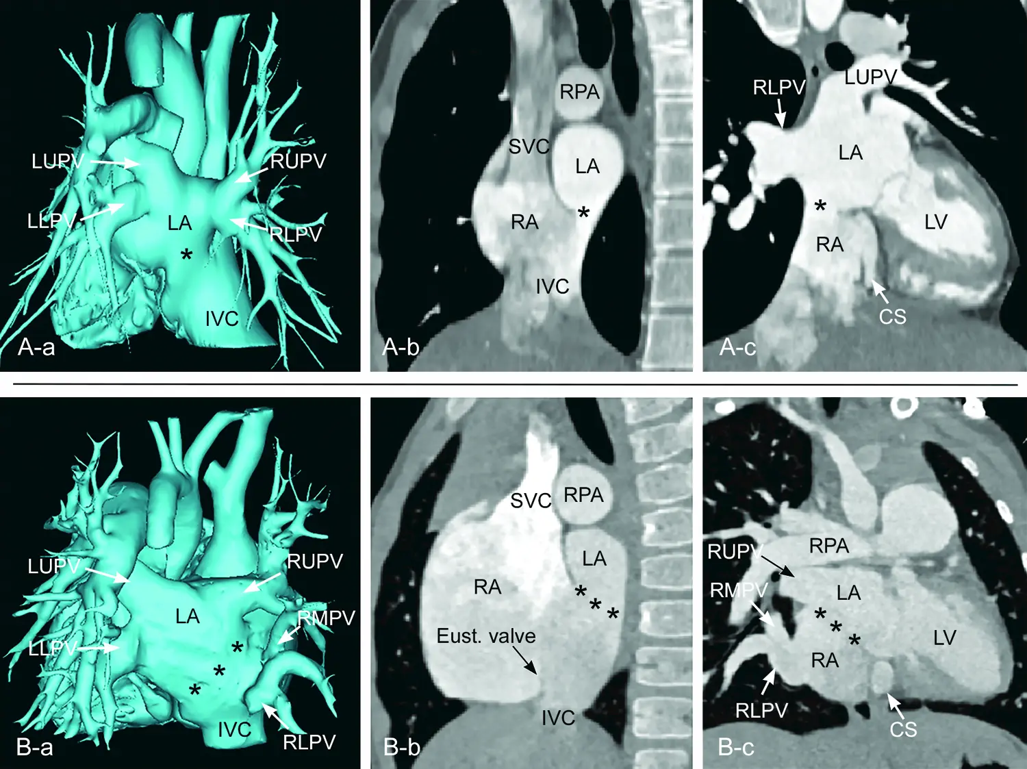 New Insights into Sinus Venosus Defects from Cross-Sectional Imaging