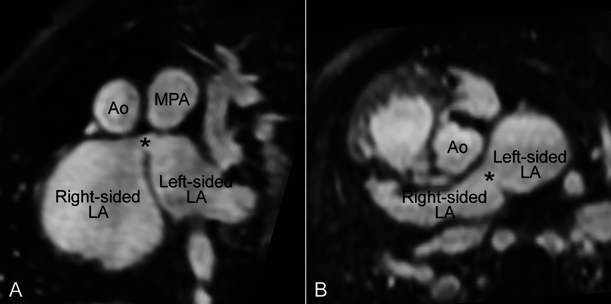 New Insights into Sinus Venosus Defects from Cross-Sectional Imaging