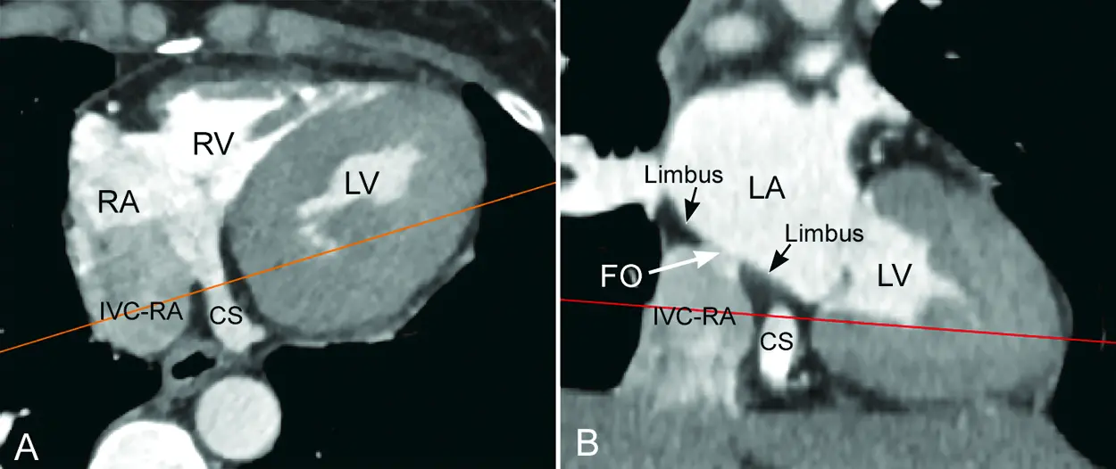 New Insights into Sinus Venosus Defects from Cross-Sectional Imaging