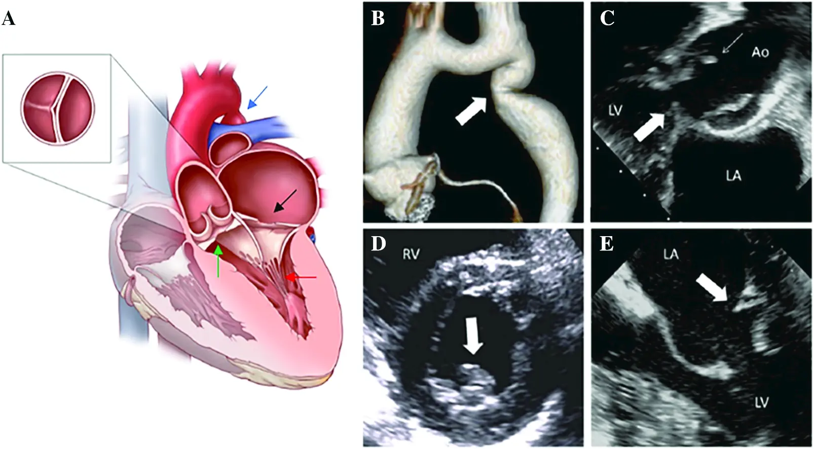 Pregnancy in Patients with Shone Complex: A Single-Center Case Series