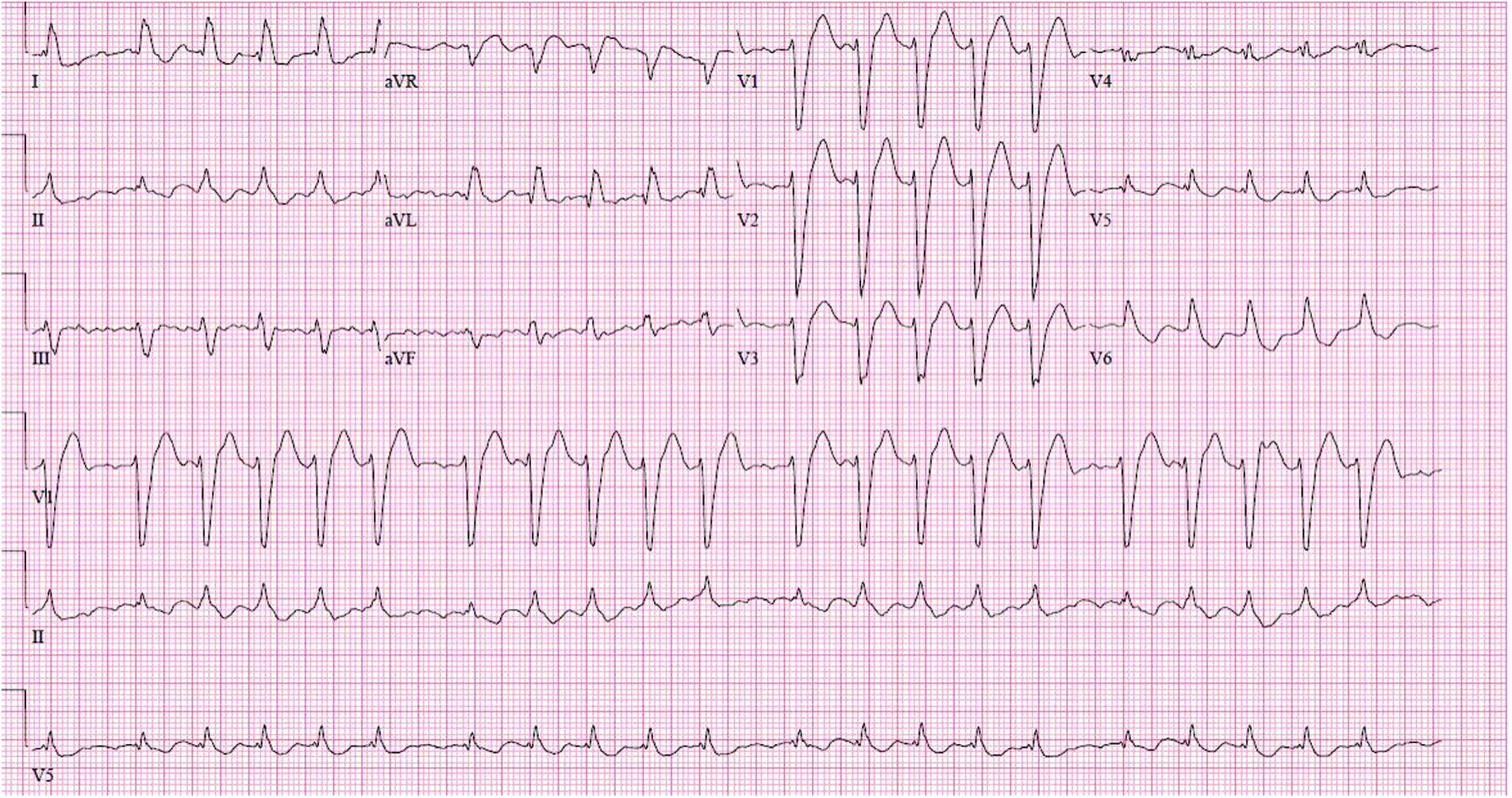 Pregnancy in Patients with Shone Complex: A Single-Center Case Series