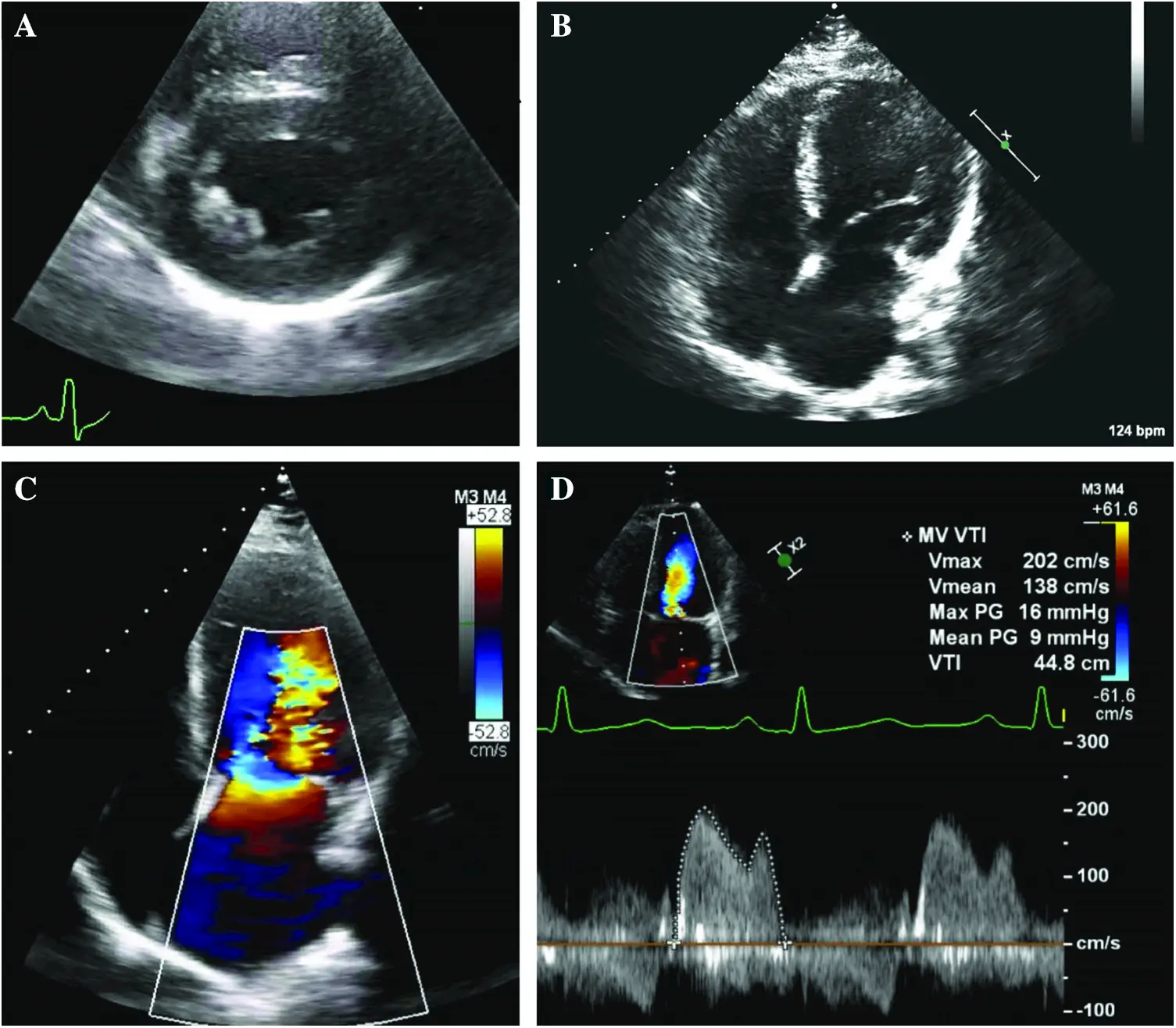 Pregnancy in Patients with Shone Complex: A Single-Center Case Series