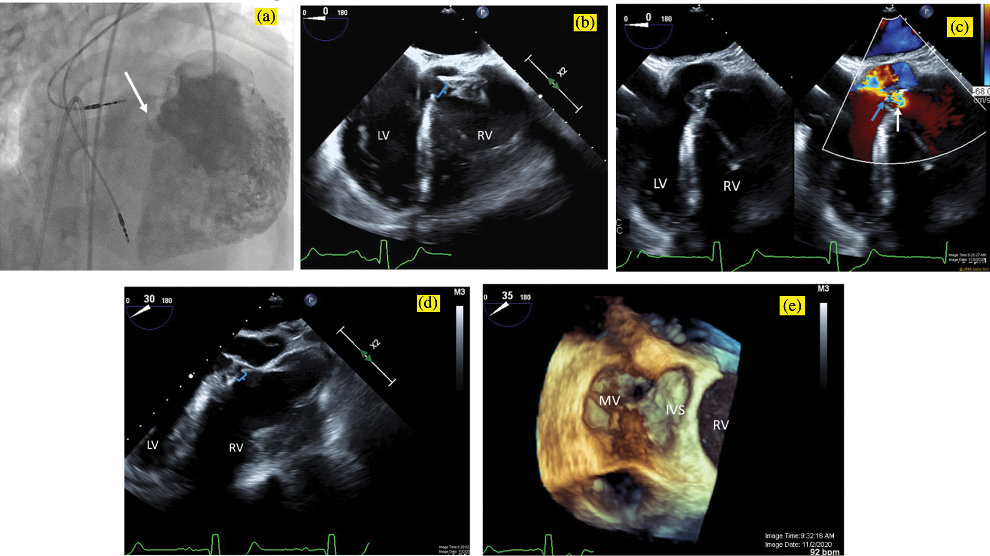 Transcatheter Device Closure of a Perimembranous Ventricular Septal ...