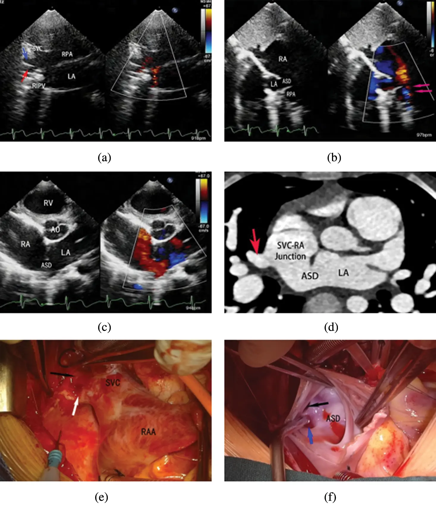 Partial Anomalous Pulmonary Venous Connection and the Nature of ...