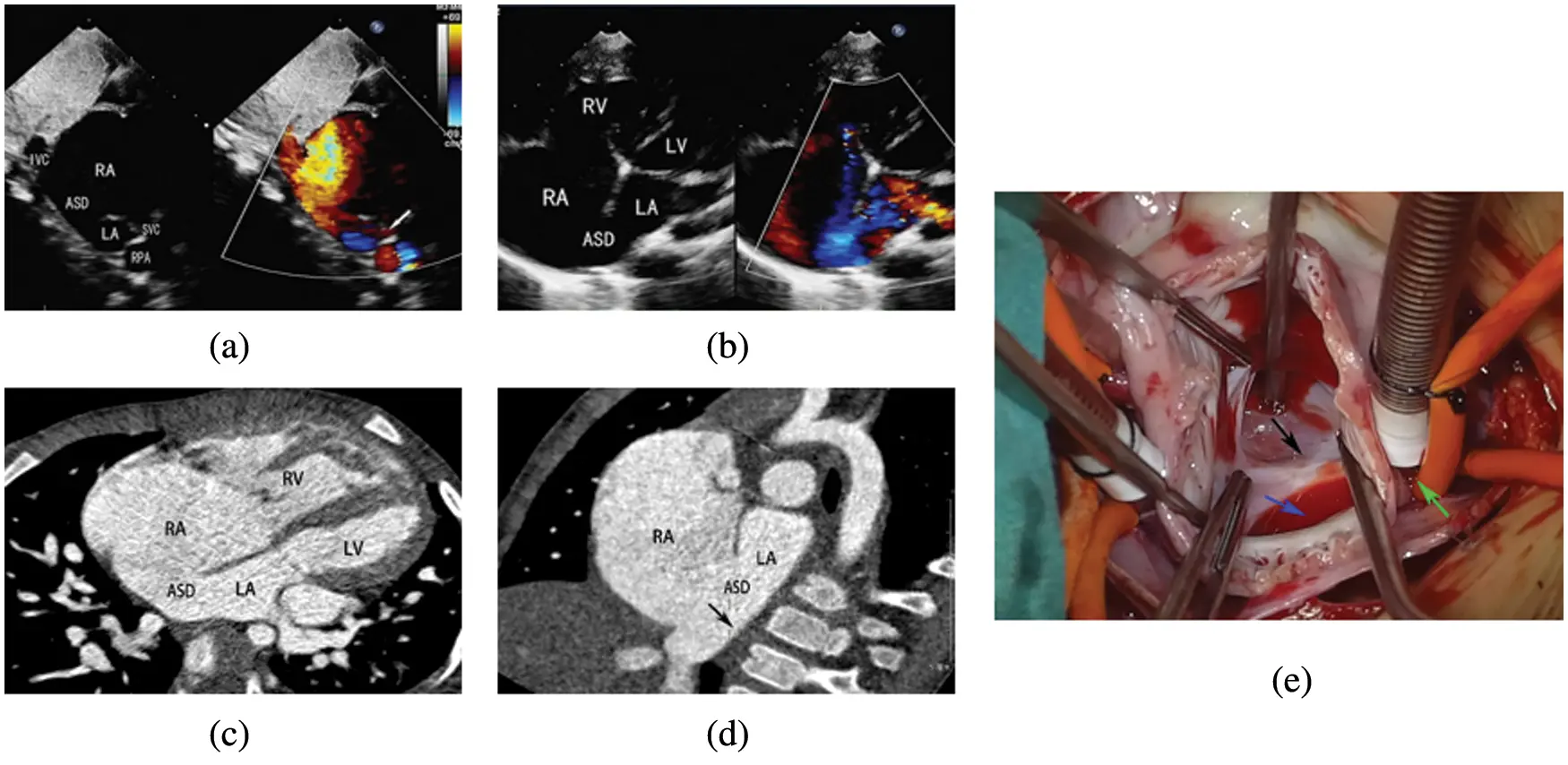 Partial Anomalous Pulmonary Venous Connection and the Nature of ...