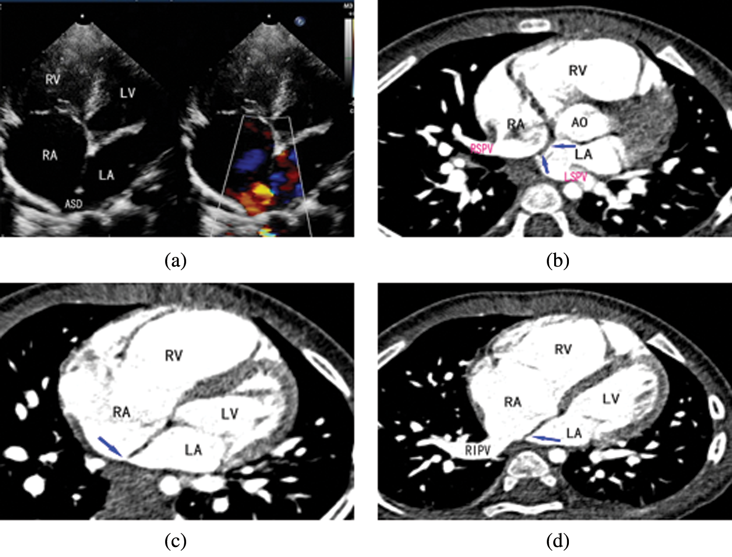 Partial Anomalous Pulmonary Venous Connection and the Nature of ...