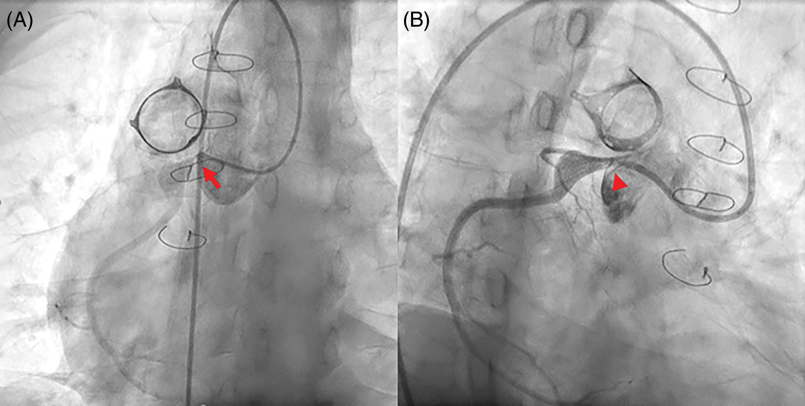 Coronary Artery Complications after Right Ventricular Outflow Tract ...
