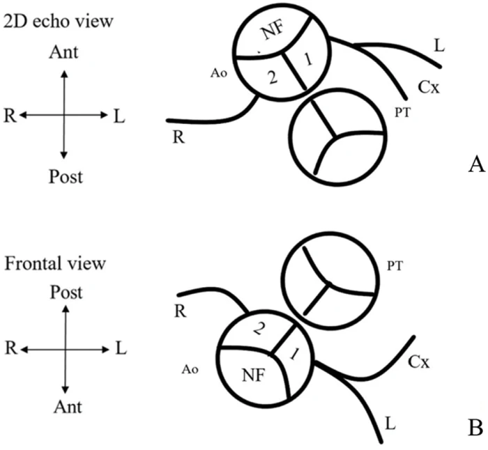 Transposition Of The Great Arteries Coronary Artery Anatomy